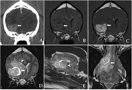 Frontiers | Endoscopy-assisted resection of a sphenoid-wing meningioma ...