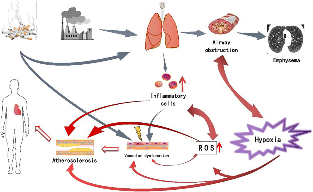 Frontiers | Analysis of pathogenesis and drug treatment of chronic obstructive pulmonary disease ...