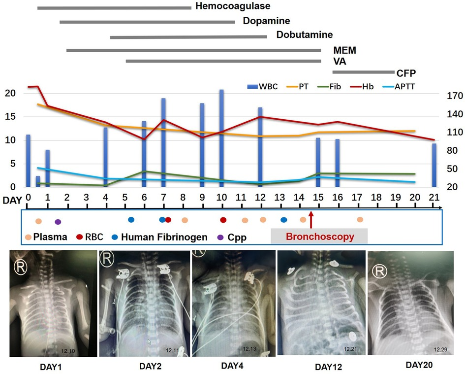 Frontiers | Ultra-slim flexible bronchoscopy-guided topical hemostatic ...