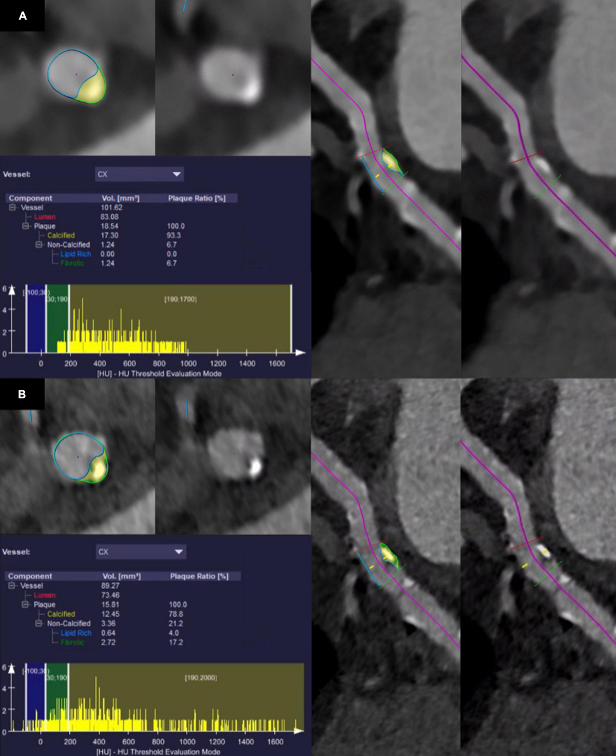 Frontiers | First in-human quantitative plaque characterization with ...