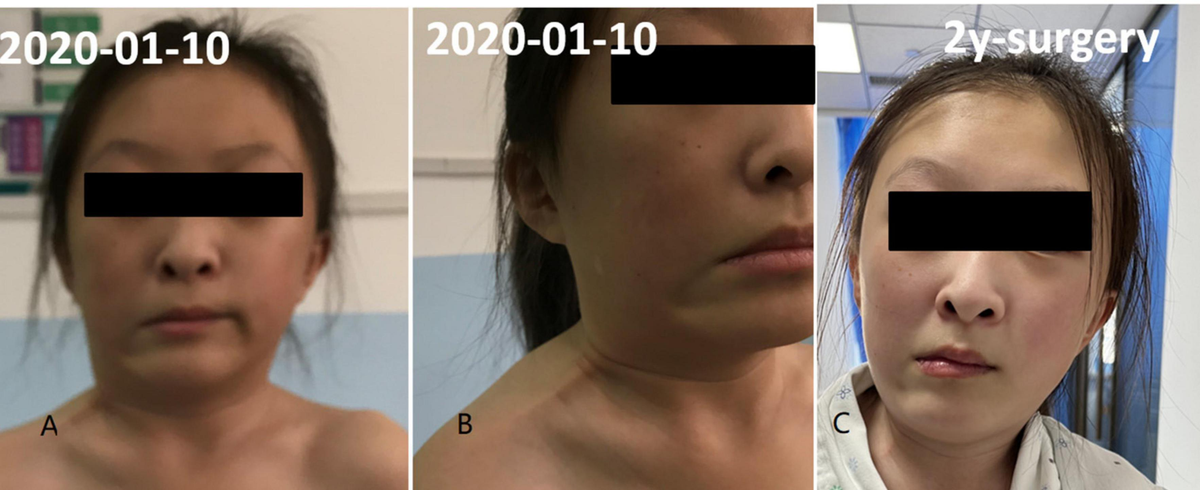 Frontiers | Fibrodysplasia ossificans progressiva: A rare disease with ...