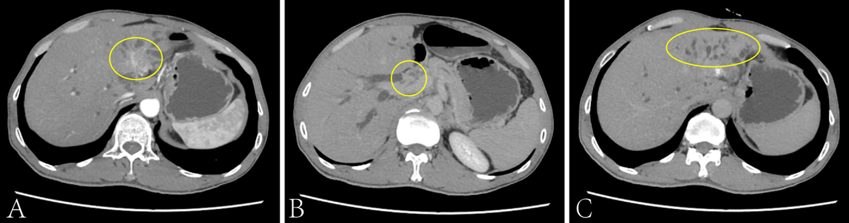 Frontiers | Case report: The MSI-L/p-MMR metastatic rectal cancer ...