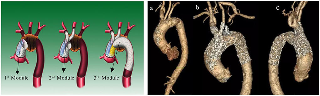 Frontiers | Hemodynamic numerical simulation of aortic arch modular ...