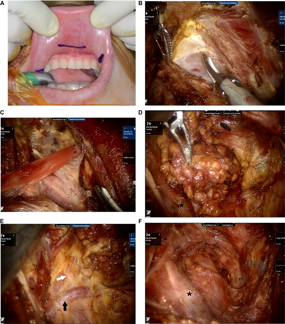 Frontiers | Feasibility of transoral robotic selective neck dissection ...