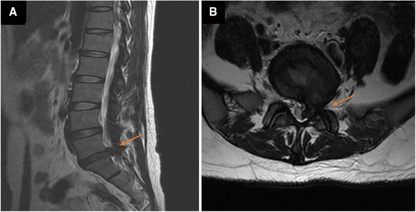 Frontiers | Percutaneous endoscopic drainage for acute long segment ...