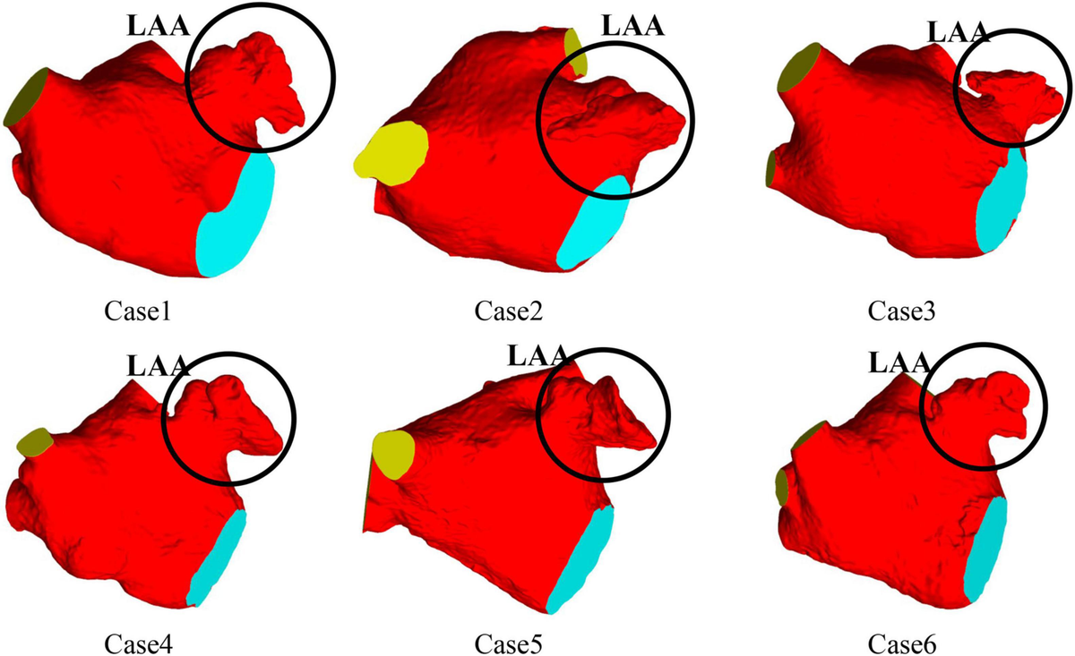 Frontiers | Numerical study of the risk of thrombosis in the left ...
