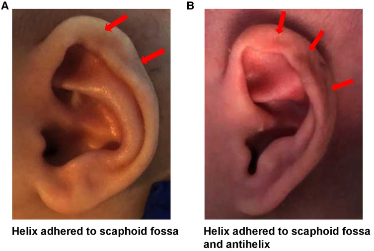 Frontiers | Using ear molding to correct auricular helix adhesion deformity