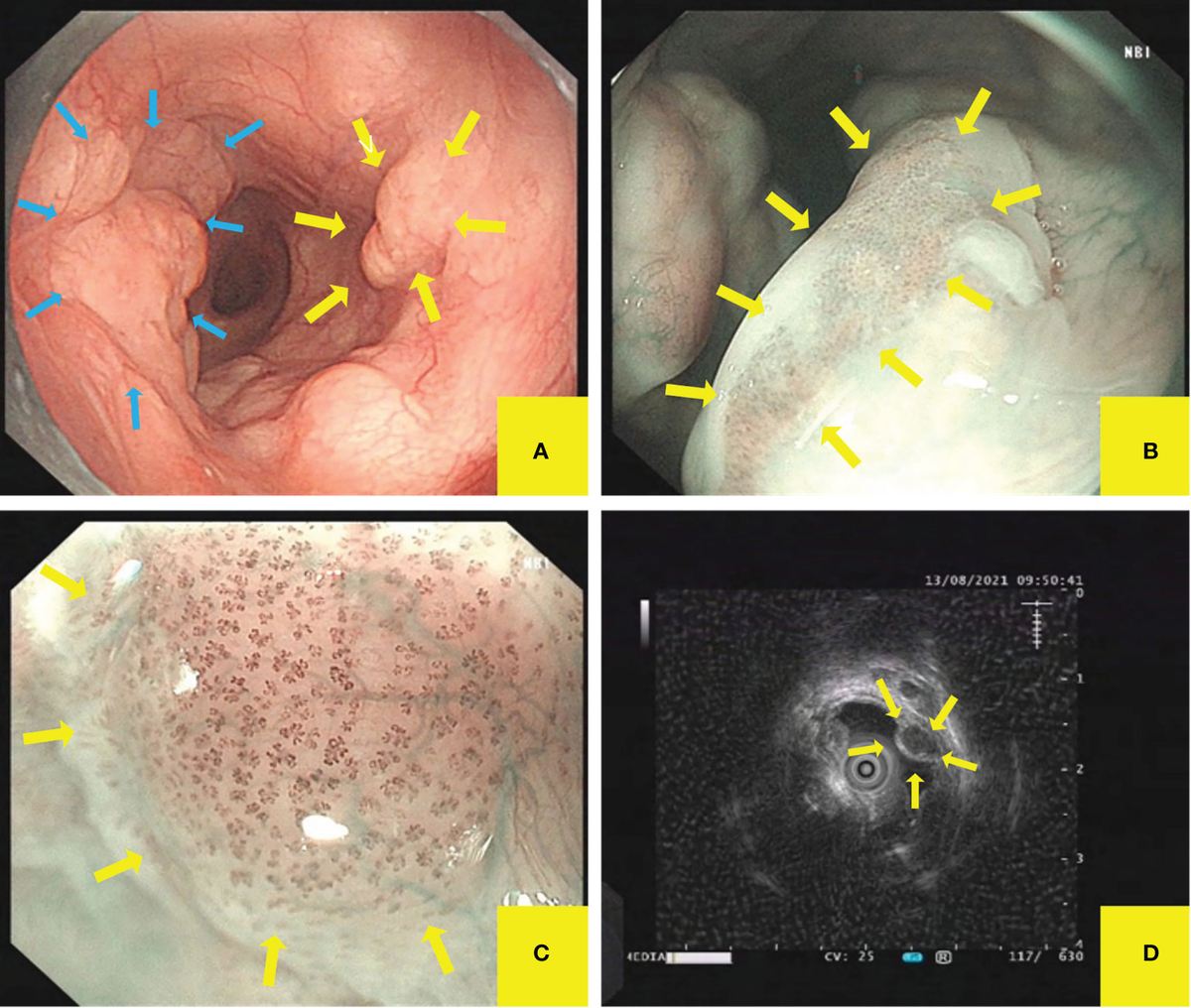 Frontiers | Esophageal low-grade intraepithelial neoplasia overlying ...