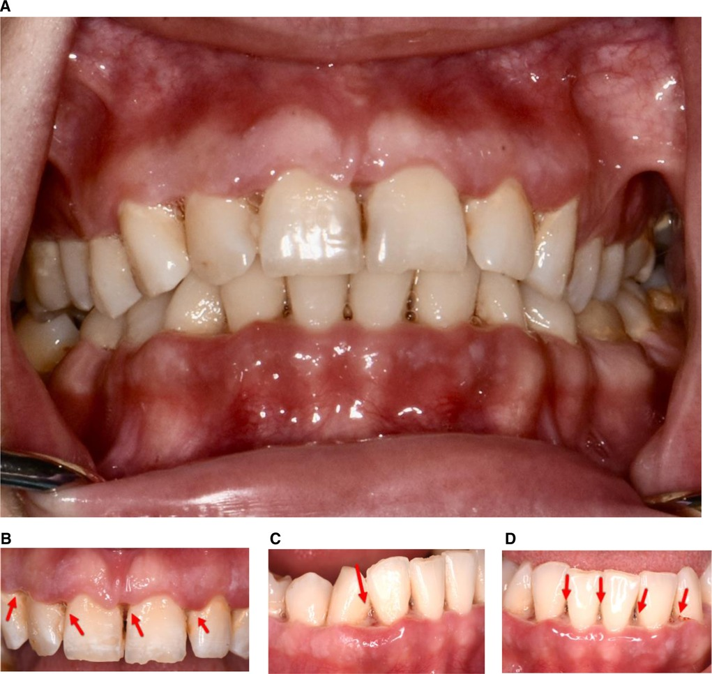 Gingivitis Ulcerosa Necrosante Acute Necrotizing Ulcerative Gingivitis