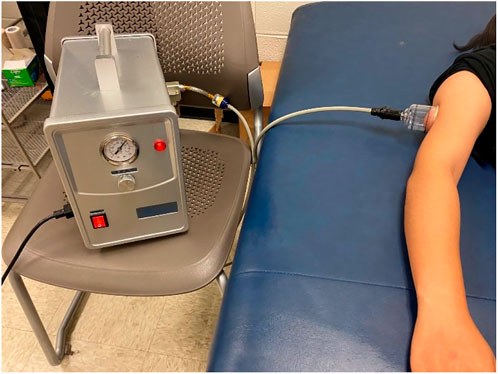 Frontiers | Effect of durations and pressures of cupping therapy on ...