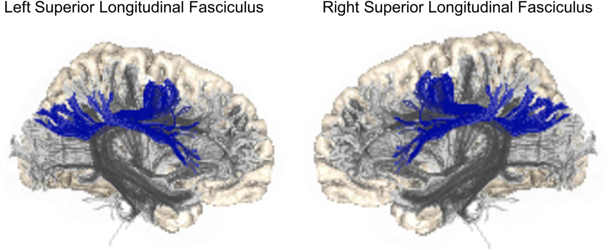 Frontiers | Segmental abnormalities of superior longitudinal fasciculus ...