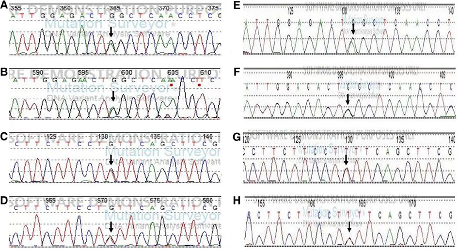 Frontiers | Glycogen storage disease type Ia misdiagnosed as multiple ...