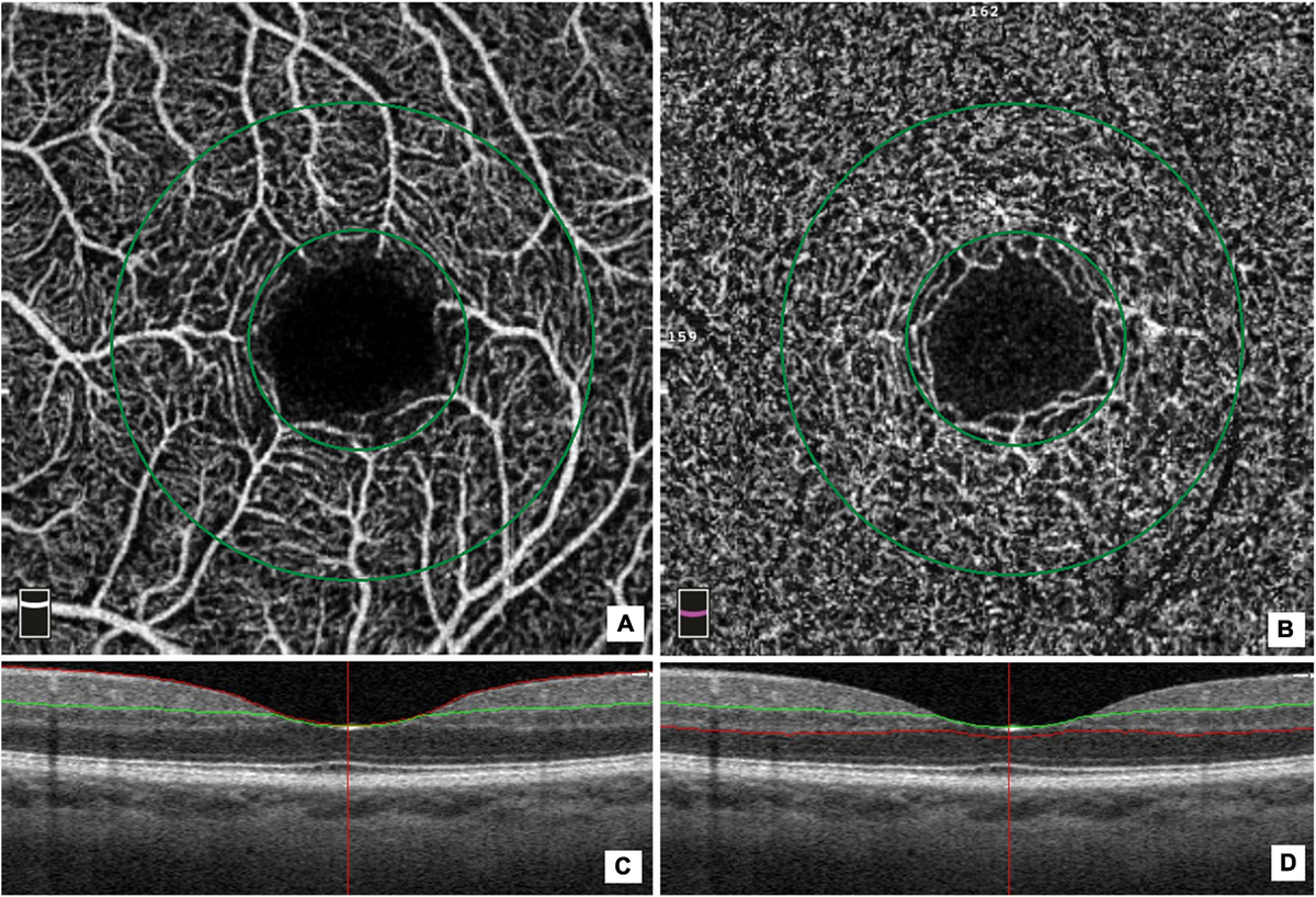 Frontiers | Correlation between retinal vessel rarefaction and ...