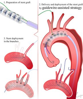 double arch aorta surgery
