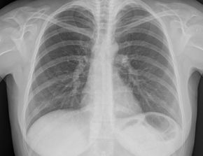 miliary tb infectious