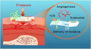 pressure ulcers pathophysiology