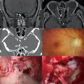 cavernous hemangioma eye socket