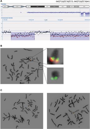 monosomy 21 disorder