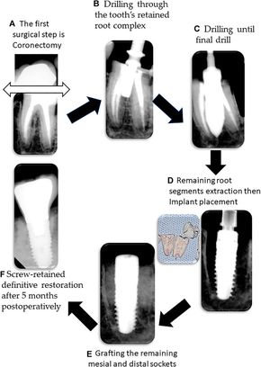 interradicular bone crest