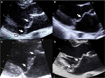 mitral valve leaflets thickened