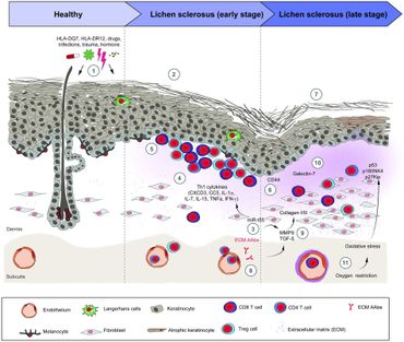 lichen simplex chronicus vulvar