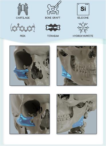titanium implants face