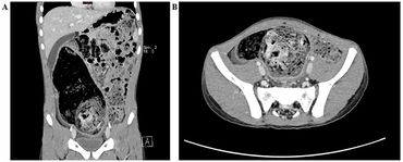 fecalith obstruction