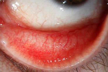 follicular conjunctivitis differential
