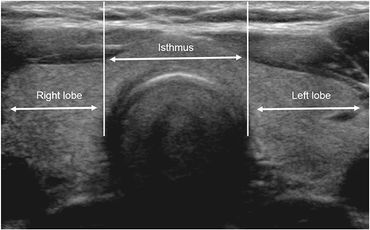 isthmus thyroid normal size