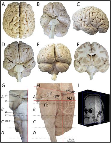 quadrigeminal plate function