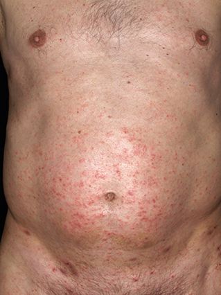 scabies on tummy