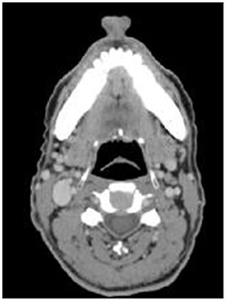 normal pharynx ct