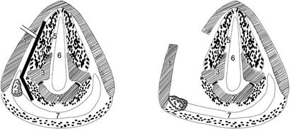 paraglottic space 3d