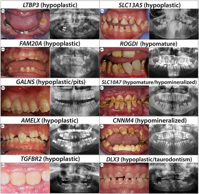 dentinogenesis imperfecta types