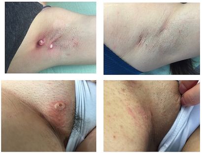 hidradenitis suppurativa permanent cure