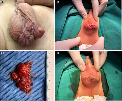 fibroepithelial polyps vulva
