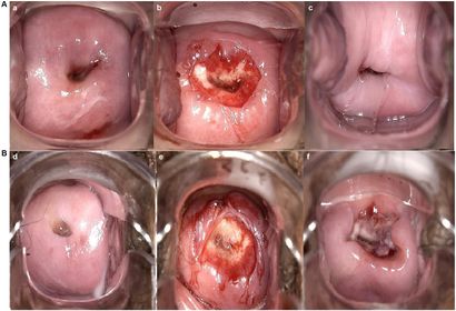 cervical ectropion bleeding