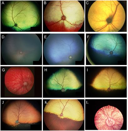abnormal fundus exam