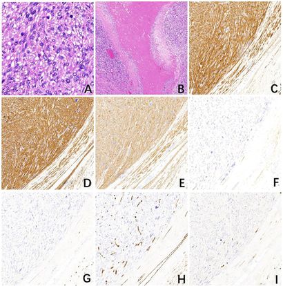 leiomyosarcoma bowel