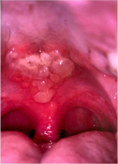 inside throat swelling