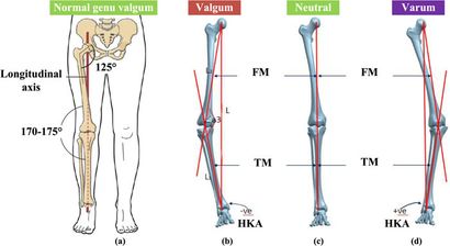 q angle valgus
