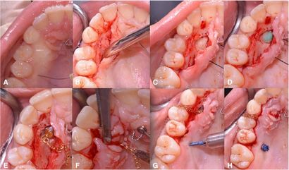 sharp canine teeth surgery