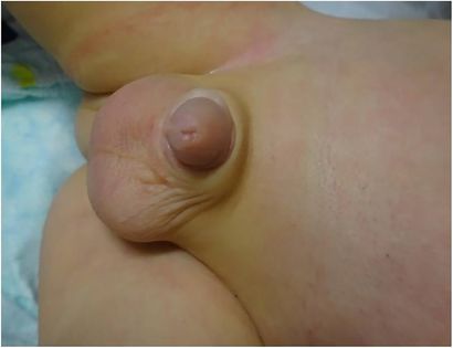 soft glans syndrome example