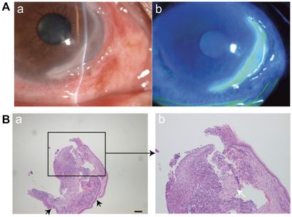 dendritic pattern corneal ulcer