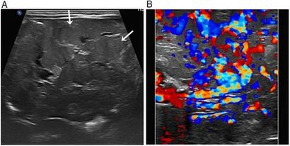 infantile hemangioma ultrasound