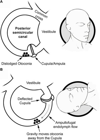 otoconia bppv