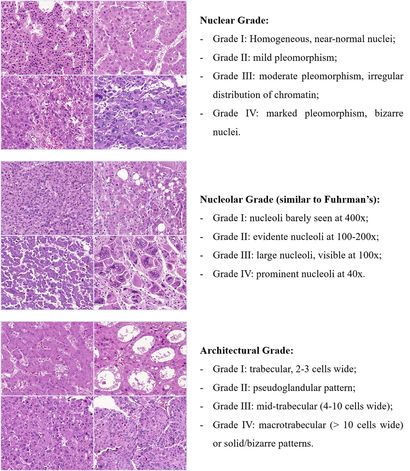 trabecular pattern histology