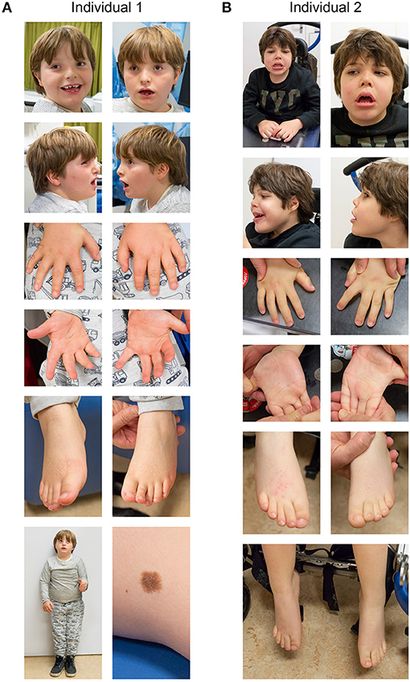 chromosome 1 missing