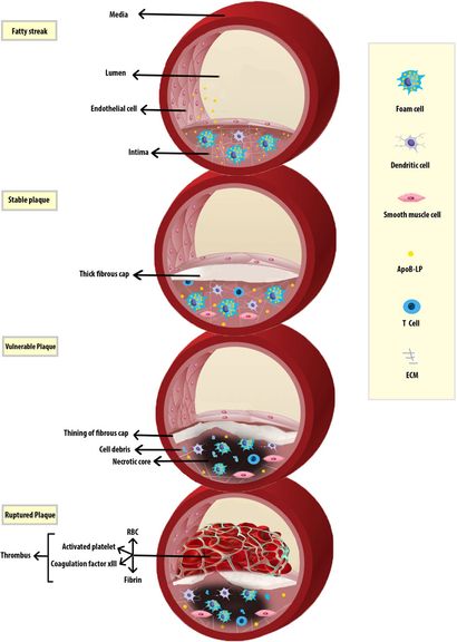 atherosclerosis pathogenesis calgary