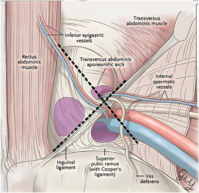 deep inguinal ring cadaver